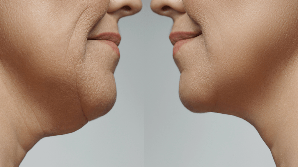 Relâchement cutané – LYSSA SELECT